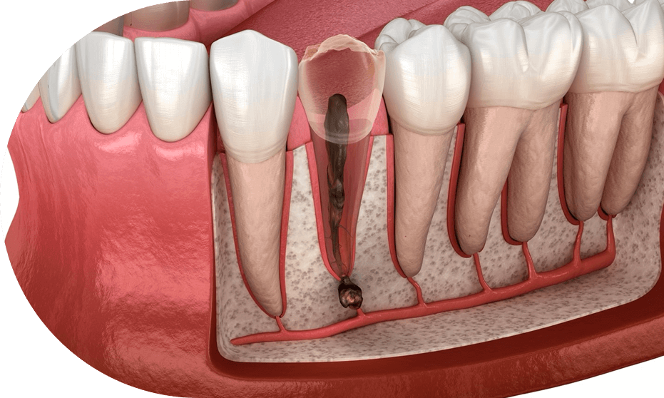 Root Canal Therapy in Allen, TX